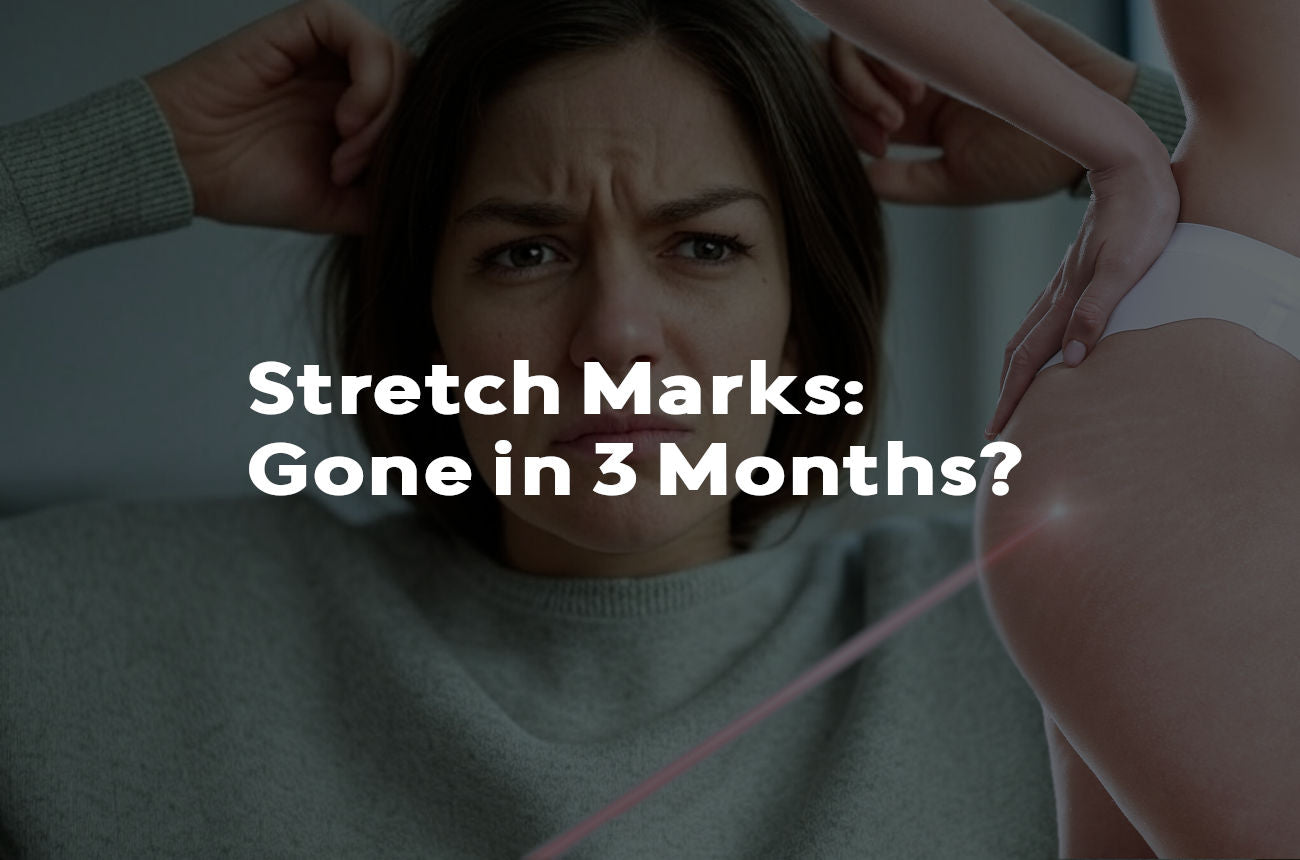 Can Stretch Marks Fade in 3 Months? A Comprehensive Guide – NUE ...